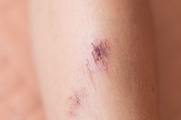 Koreng Bikin Tampilan Kurang Oke, Hilangkan Pakai 5 Bahan Alami Ini ...