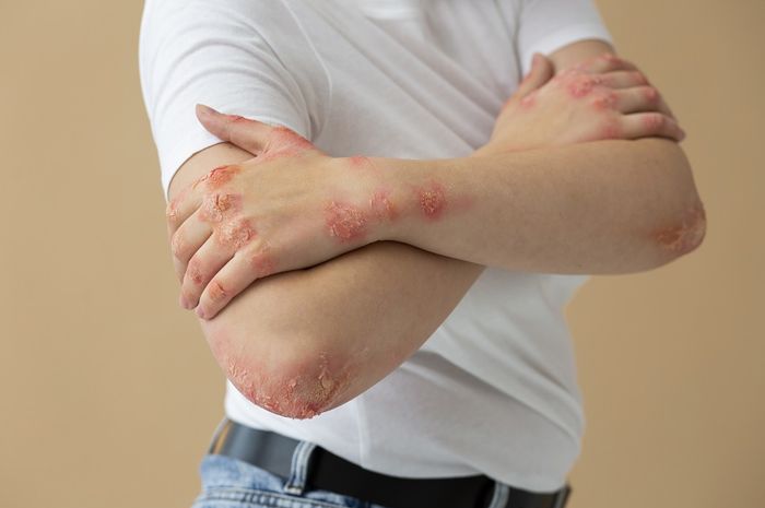 Perbedaan Gejala Eksim dan Jerawat, Perhatikan Tanda-tandanya! - Stylo