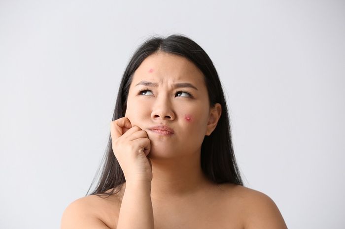 Perbedaan Jerawat dan Bisul, Bisa Muncul di Wajah dan Tubuh Lho! - Stylo Perbedaan Jerawat dan Bisul, Bisa Muncul di Wajah dan Tubuh Lho! - Stylo