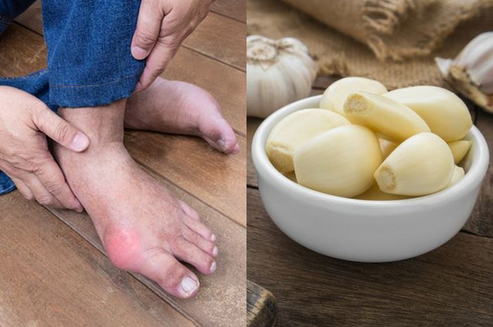 Gak Akan Kambuh Seumur Hidup, Asam Urat Langsung Bablas Dengan 1 Siung ...