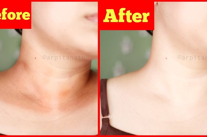 Leher Hitam, Kulit di Lutut dan Siku Kasar, Hilang dengan Bahan Makanan ...