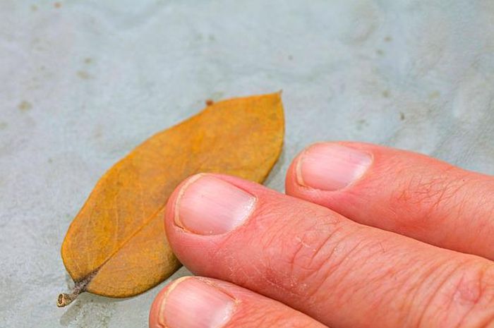 Tak Hanya Diabetes dan Infeksi Jamur, Ini 5 Penyebab Kuku Kuning, Apa ...