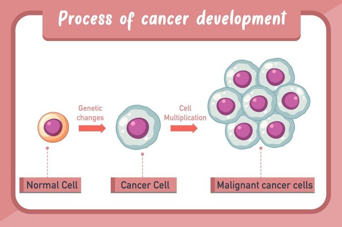 Kenapa Penyakit Kanker Harus Dikategorikan Berdasarkan Stadium? Ini ...