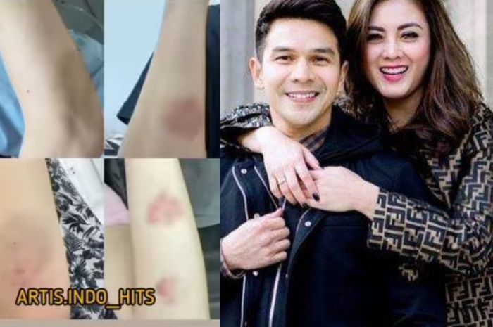 Belum Juga Berdamai, Dhena Devanka Beberkan Bukti Lebam di Tubuhnya ... Belum Juga Berdamai, Dhena Devanka Beberkan Bukti Lebam di Tubuhnya ...