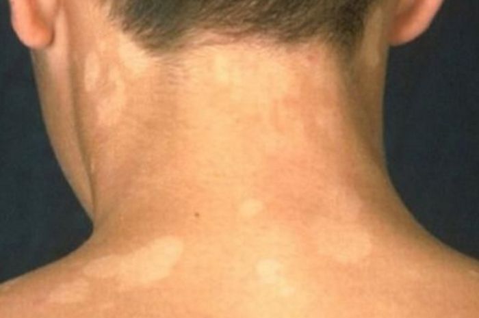 Bercak Putih di Badan Apakah Selalu Berarti Panu? Cek di Sini! - Grid ...