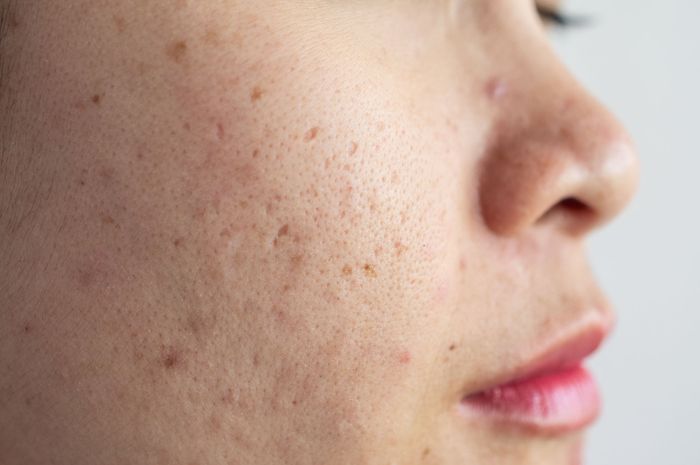 Kabar Baik Buat Wanita Se-Indonesia, Kini Wajah Bisa Mulus Bebas Dari ...