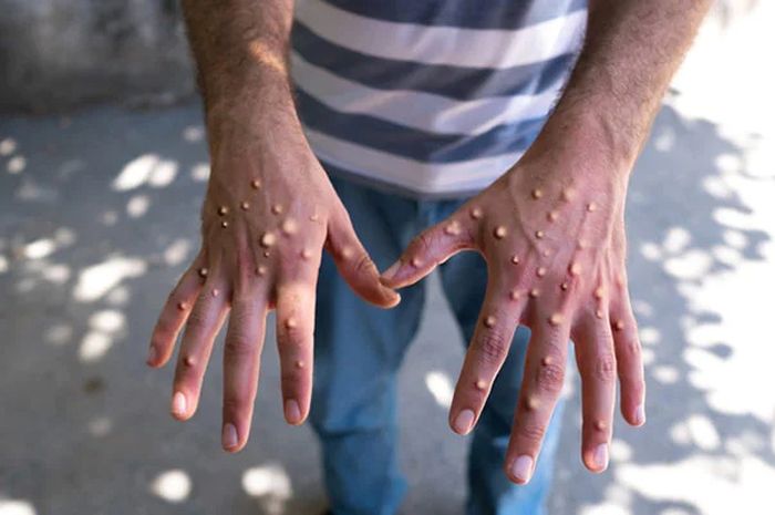 Jangan Keliru, Ini Beda Ruam Cacar Monyet dan Penyakit Kulit Lainnya ...