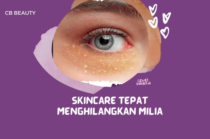 Apa Itu Milia dan Skincare yang Tepat untuk Menghilangkannya - CewekBanget