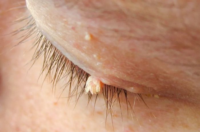 Menghilangkan Kutil di Sekitar Mata, Cukup Pakai 5 Bahan Alami Ini ...