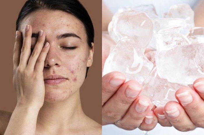 Segera Dirawat Biar Tak Jadi Bopeng, Begini Cara Mengatasi Jerawat ...