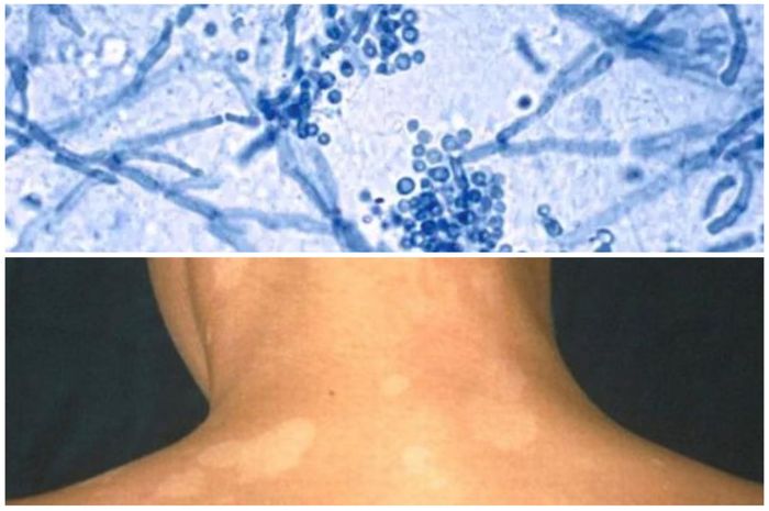 Apakah Panu Berbahaya? Ternyata Disebabkan karena Perkembangan Jamur ...