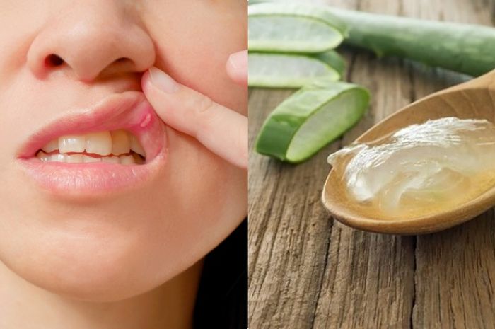 6 Obat Sariawan Alami Bisa Dibuat di Rumah, Madu Hingga Lidah Buaya ...