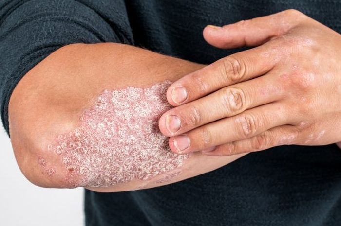 Ketahui Ciri Khas Penyakit Psoriasis, Kondisi Kulit Seperti Ini - Grid ...