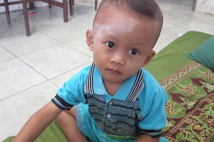 Penyebab Munculnya Bercak Putih di Wajah Anak dan Cara Mencegahnya ...