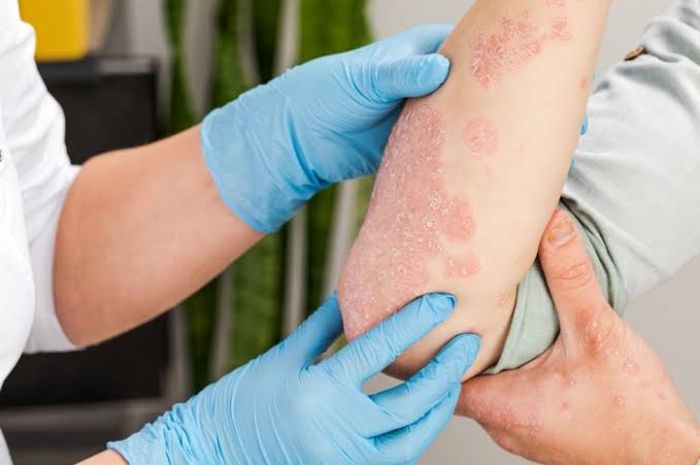 Kenali 3 Prosedur Medis Pengobatan Psoriasis untuk Redakan Gejalanya - Grid Health