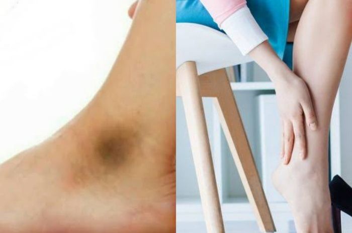 Sudah Rajin Pakai Lotion Pemutih Gak Ada Perubahan, Mata Kaki yang ...