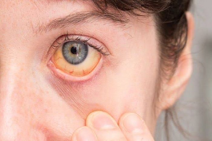 5 Penyebab Penyakit Mata Kuning yang Tidak Boleh Disepelekan - Grid Health