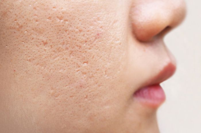 Gak Bisa Ditutupi Make Up, Bopeng Bekas Jerawat Nyatanya Bisa Hilang ... Gak Bisa Ditutupi Make Up, Bopeng Bekas Jerawat Nyatanya Bisa Hilang ...