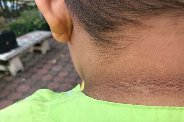 Dikira Cuma Daki, Ternyata Leher Hitam Bisa Jadi Tanda Tubuh Terserang ...