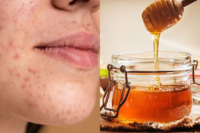 Nyesel Beli Skincare Mahal Gak Mempan, Padahal Beruntusan Di Wajah Bisa ...