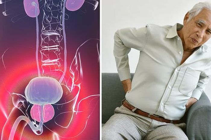 Sering Mengalami Sakit di 3 Bagian Tubuh Ini, Bisa Jadi Tanda Kanker Prostat - Halaman 1 - Grid ...