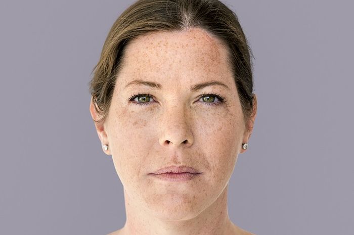 Nggak Pede Warna Kulit Tidak Rata, Ini Cara Menghilangkan Melasma di ...