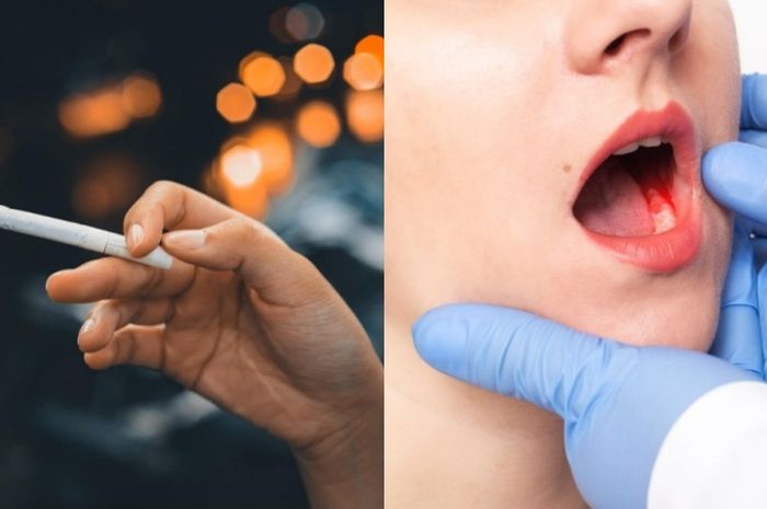 Perokok Berisiko 10 Kali Lipat Alami Kanker Mulut, Apa Saja ...