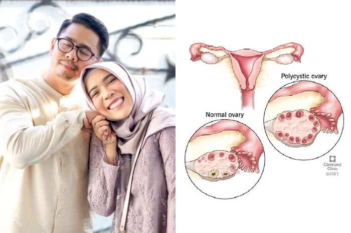 Fitri Tropica Sempat Sulit Punya Momongan Karena Penyakit PCOS ...