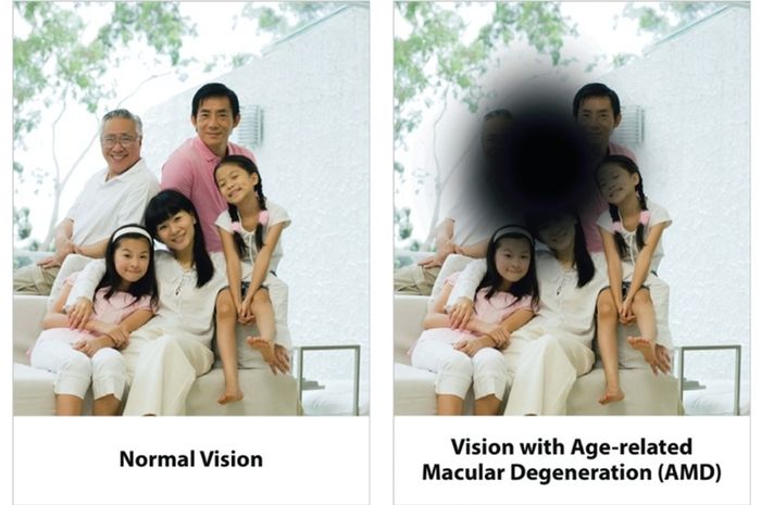 Mengenal Penyakit Mata Makula dan Penyebabnya, Bisa Sebabkan Kebutaan ...