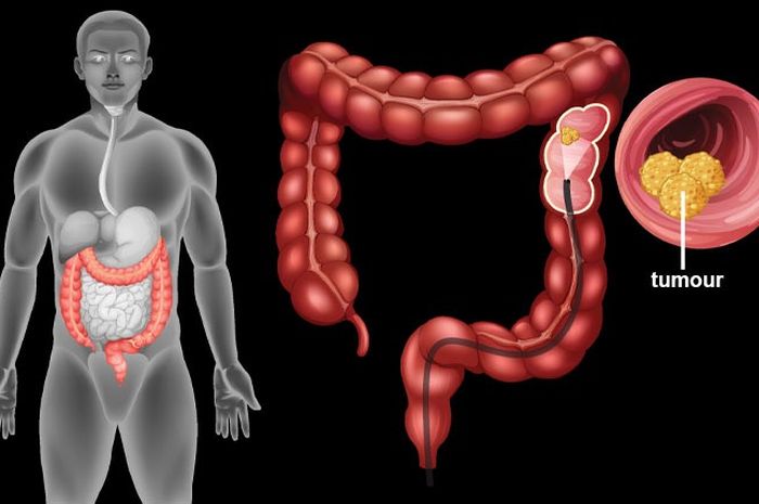 Apa yang Dirasakan Penderita Kanker Usus Diawal Diagnosa? Ketahui Juga ...