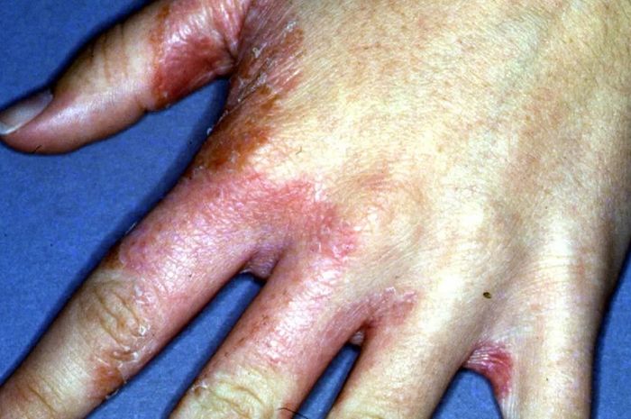 Penyebab Kutu Air di Tangan, Ini Cara Mengobati dengan Bahan Alami ...