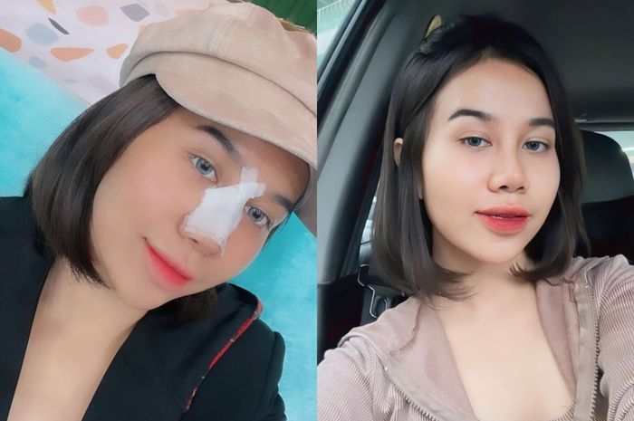 Hidung Baru Hasil Operasi, Mayang Ngaku Jadi Lebih Percaya Diri