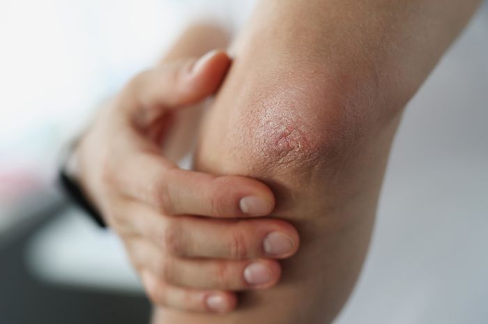 Terawat! Gini 5 Cara Cepat Mengatasi Kulit Siku yang Kering dan Hitam ...