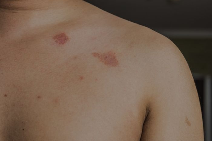 Sebelum Terlambat, Inilah Cara Jitu Mencegah Penyakit Kurap di Kulit ...