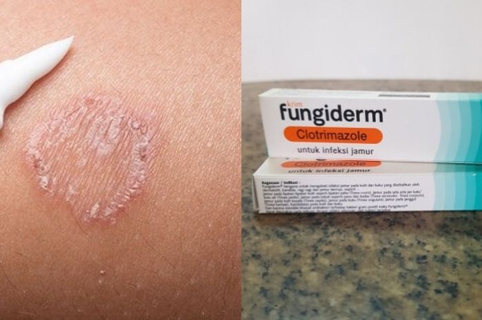 5 Rekomendasi Obat Kurap di Apotek yang Efektif dan Aman Digunakan ...