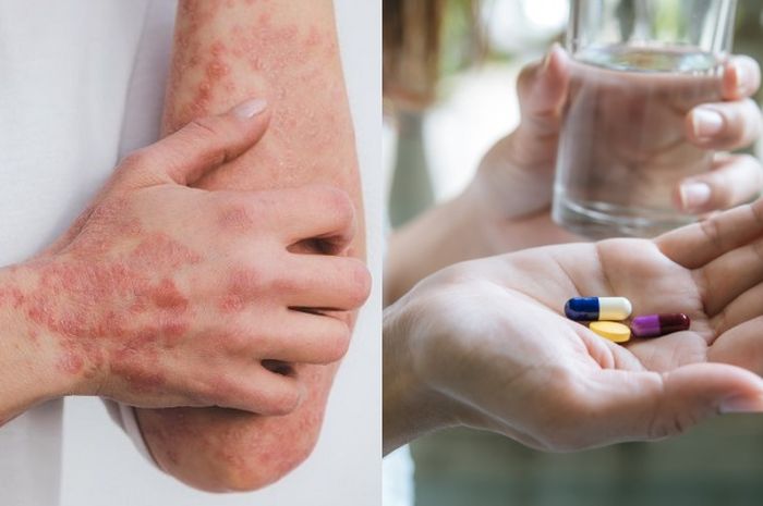 3 Obat Kurap Oral yang Diminum, Kelebihannya dan Efek Sampingnya - Grid ...