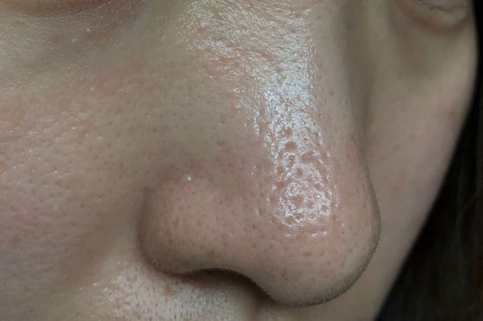 Lakukan 5 Perawatan Ini Untuk Mengatasi Pori-Pori Hidung yang Besar ...