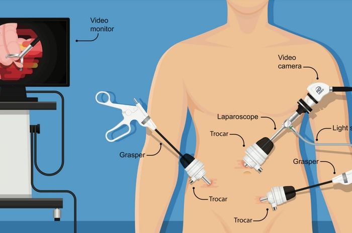 Teknik Bedah Laparoskopi, Manfaat dan Risiko yang Didapatkan dari Operasi Ini - Semua Halaman ...