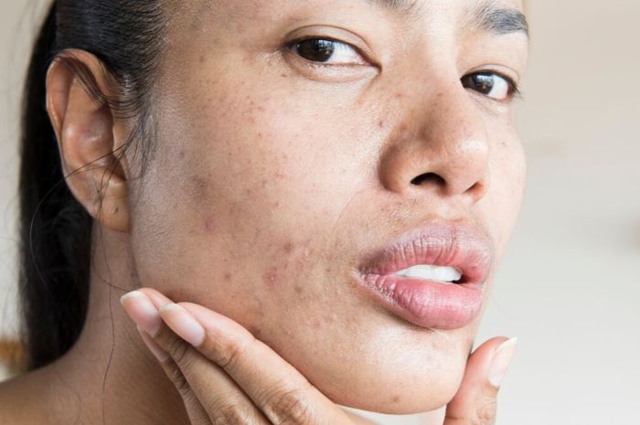 Berapa Lama Bekas Jerawat Hitam Dapat Hilang? Wajib Tahu Fakta Ini! - Stylo