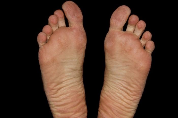 Cara Menghilangkan Mata Kaki Hitam dan Kasar, Pakai Ini Supaya Cepat ...