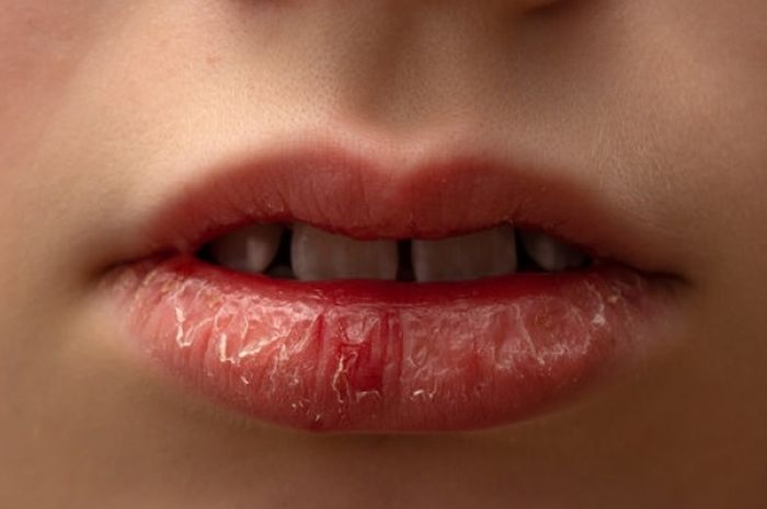 Trik Mengatasi Bibir Pecah-pecah Cuma dengan Bahan dari Dapur, Tidak ...