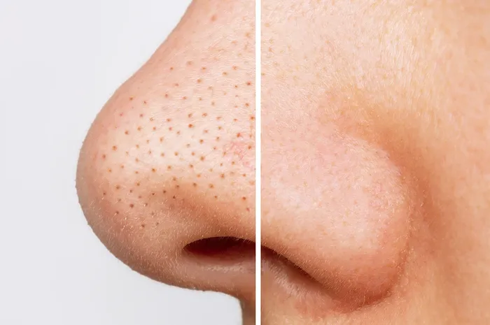 Jangan Dipencet! Gini 4 Cara Menghilangkan Komedo Hitam di Hidung ...