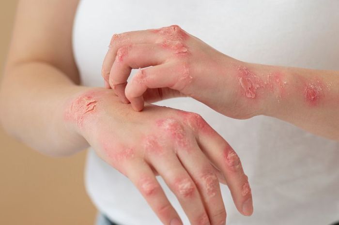 Kenali Tanda Dermatitis Atopik, Apakah Gejalanya Sama dengan Alergi ...