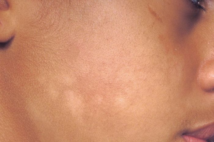 Tanda Bercak Putih di Muka, Begini Cara Menghilangkan Panu di Wajah ...