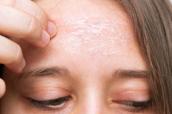 Kulit Kering Busik Bikin Orang-orang Berisik, Coba Atasi Pakai Ini! - Stylo