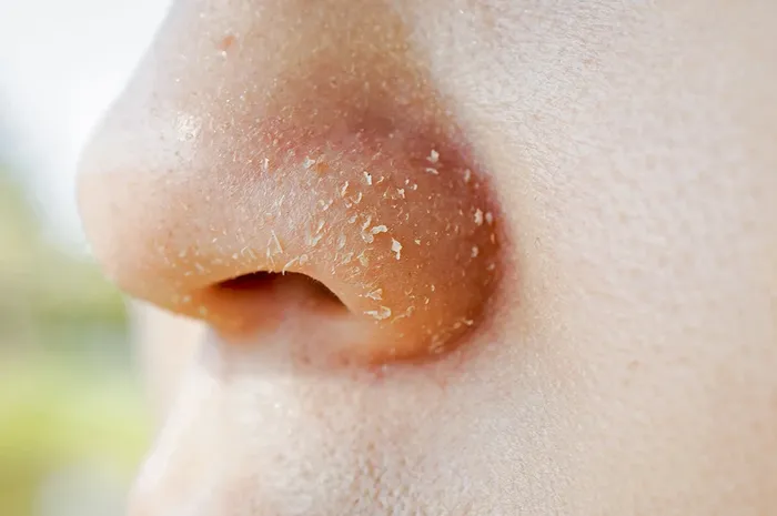 Kulit Area Hidung Kering dan Bersisik? Lakukan 8 Cara Ini Biar Halus ...