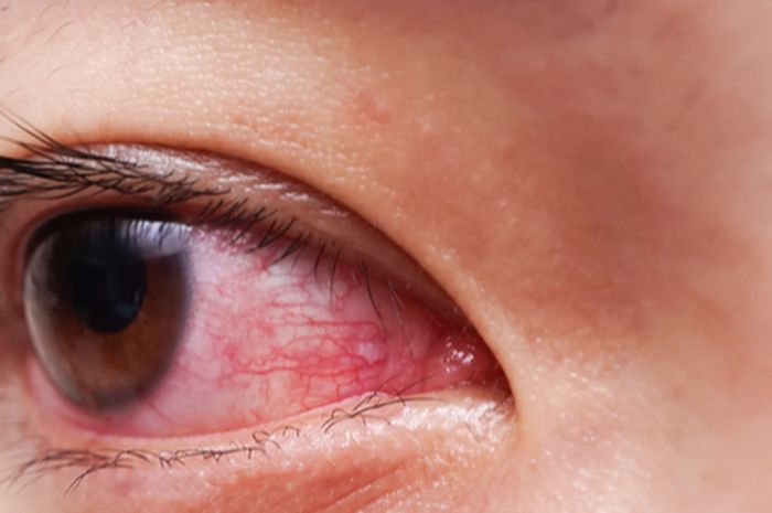 Tanpa Obat, Gunakan 4 Bahan Alami Ini untuk Mengobati Infeksi Mata ...