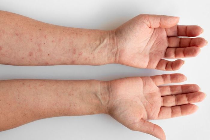 Varises Ternyata juga Bisa Muncul di Tangan, Ini Penyebab dan Cara ...