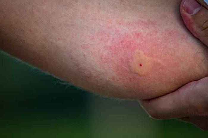 Bolehkah Memencet Bentol di Kulit Sampai Berbekas Garis Kuku? - Stylo