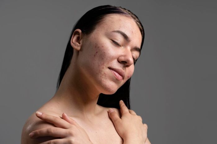 Mengatasi Wajah Rusak Akibat Paparan Merkuri, Jangan Sampai Salah ...